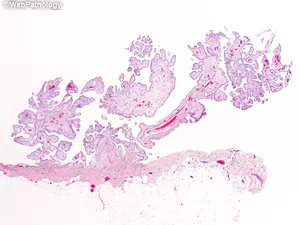 what is mesothelial hyperplasia