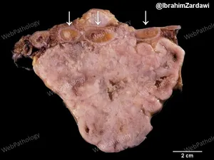 chondrosarcoma gross features