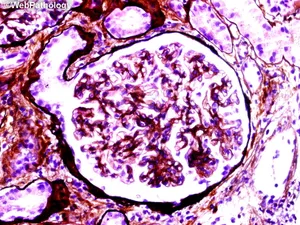 glomerular pathology