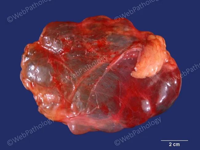 thymic cyst pathology