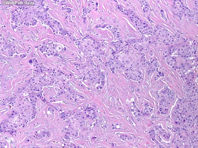 Hepatocellular Carcinoma - Schirrous Pattern