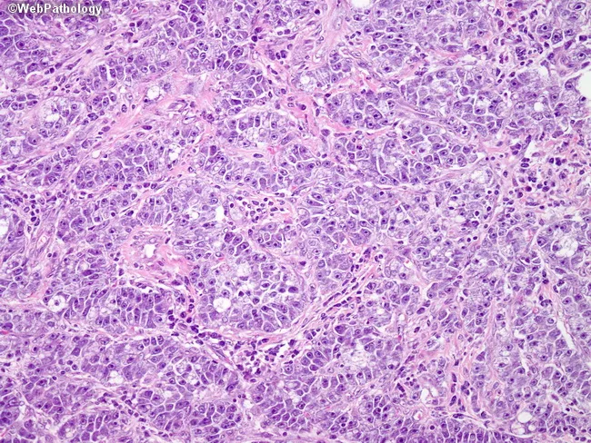 Fibrolamellar Carcinoma Of Liver