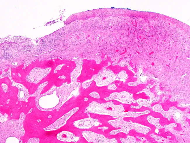 Peripheral Ossifying Fibroma : Microscopic