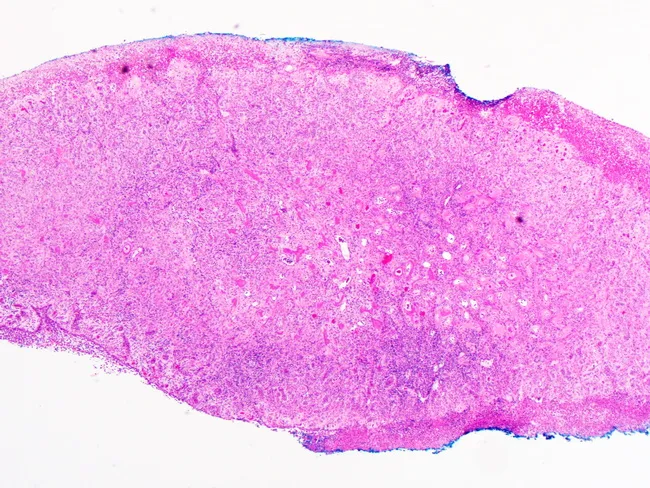 Ossifying Fibroma Oral Pathology