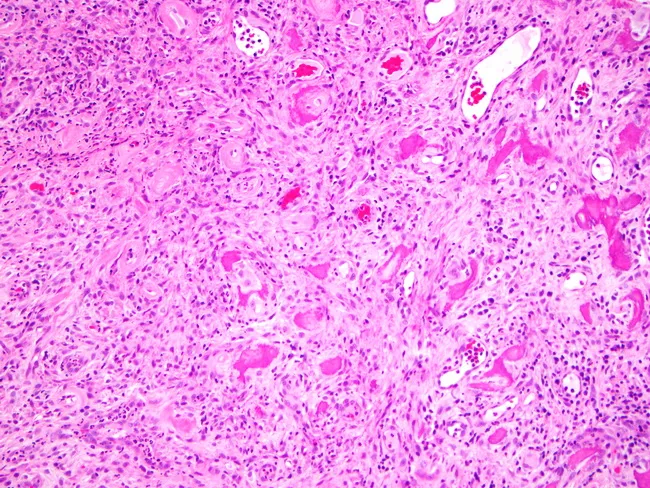 Peripheral Ossifying Fibroma : Microscopic
