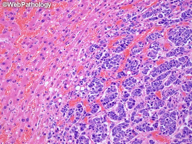 Metastatic Small Cell CA - Lung