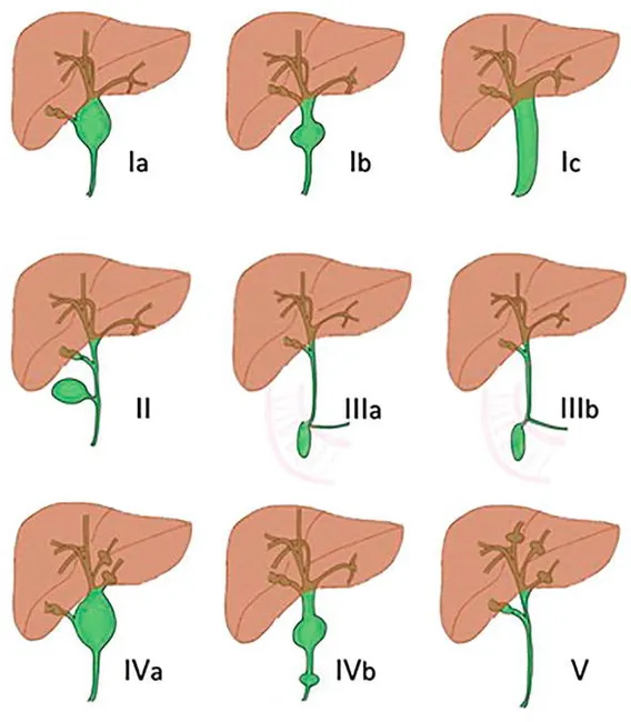 Choledochal Cyst : Todani Classification