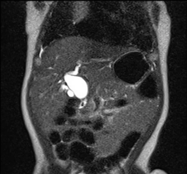 Choledochal Cyst : Imaging
