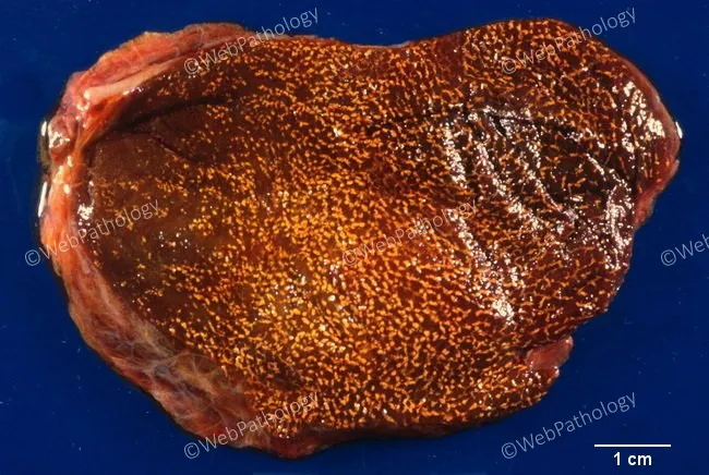 Cholesterolosis : Clinical Features