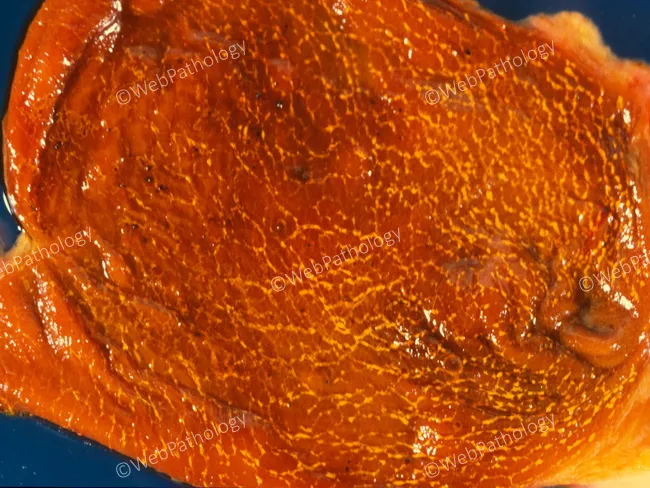 Cholesterolosis : Macroscopic Features