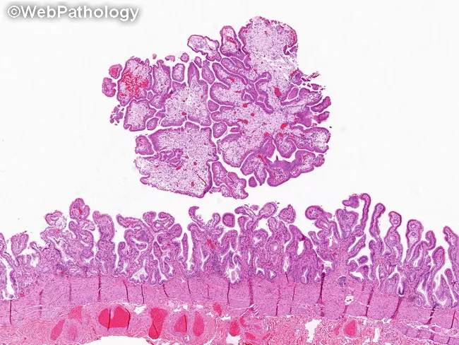 Cholesterol Polyps