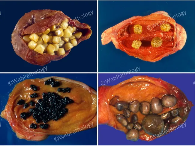 real gallbladder size