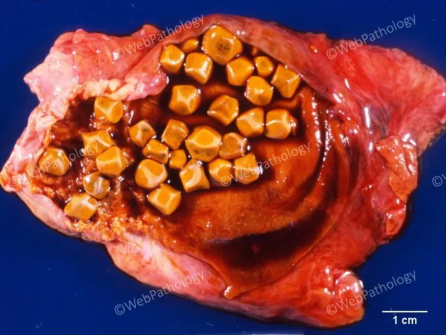 gallbladder stones