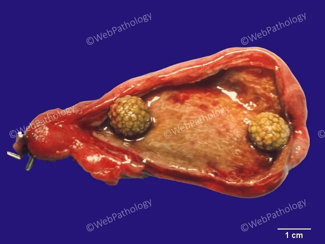 Gallstones : Biliary Colic
