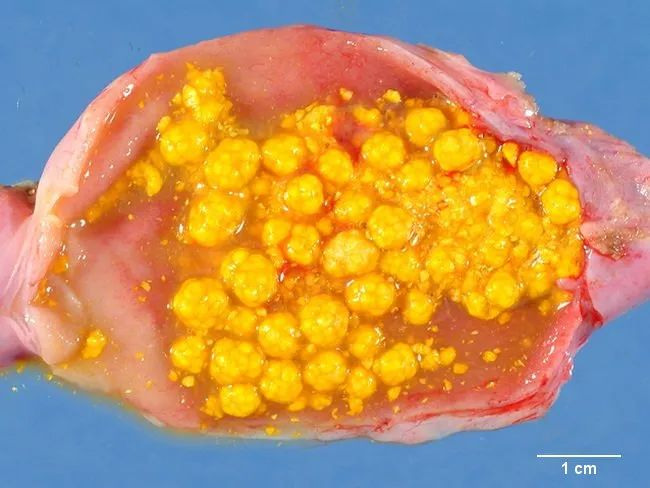 Cholesterol Gallstones : Composition