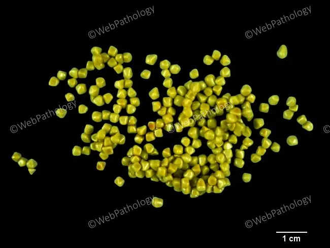Cholesterol Gallstones : Composition