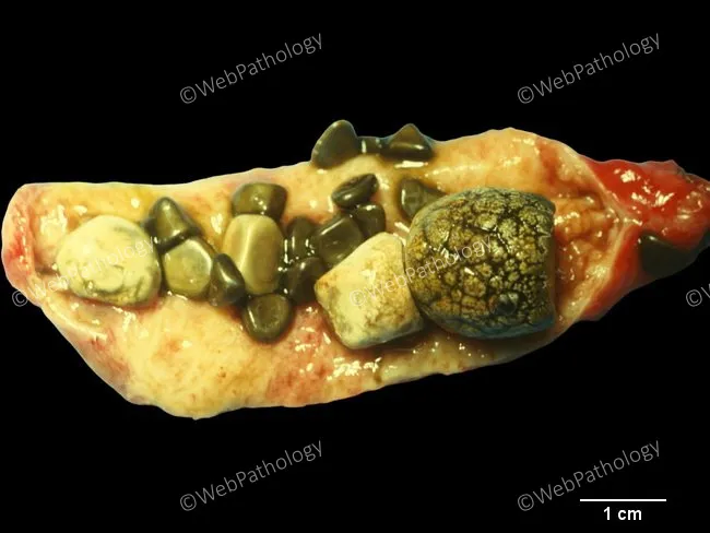 real gallbladder size