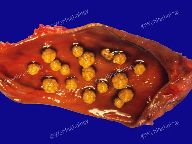 Cholesterol Gallstones : Risk Factors