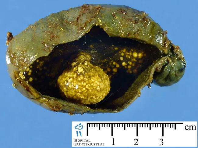 Cholesterol Gallstones : Pathophysiology