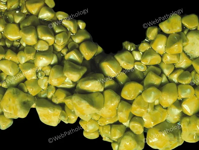 Cholesterol Gallstones : Pathophysiology