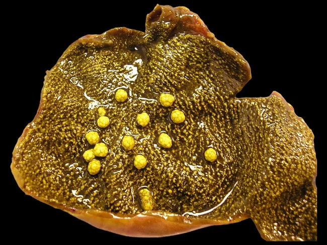 Cholesterol Gallstones & Cholesterolosis