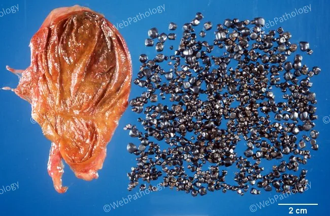 Black Pigment Gallstones : Appearance