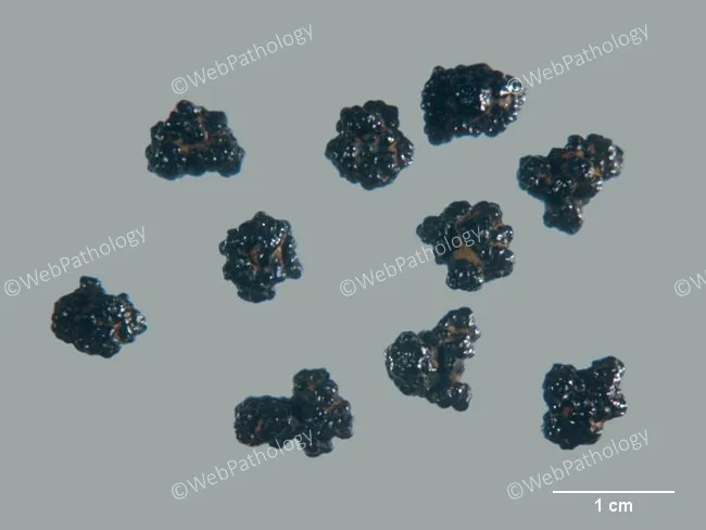 Black Pigment Gallstones : Appearance