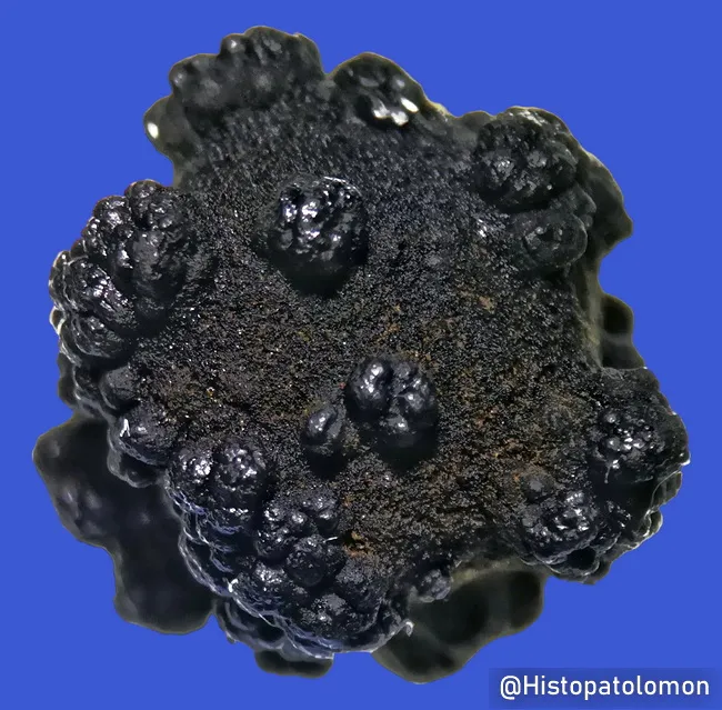 Black Pigment Gallstone : Pathophysiology