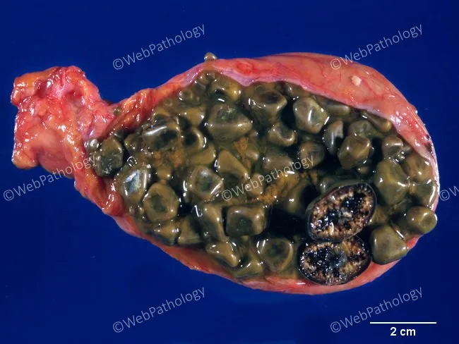 Black Pigment Gallstones : Pathophysiology
