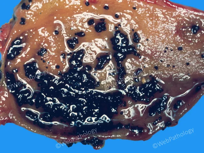 Chronic Hemolysis & Pigment Gallstones