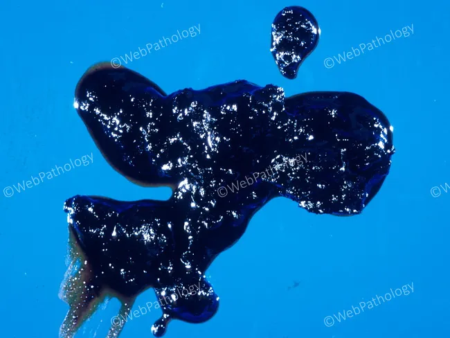 Biliary Sludge & Gallstones