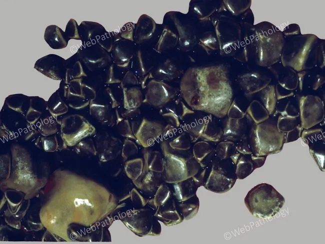 Black Pigment Gallstones