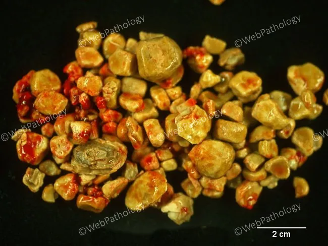 Brown Pigment Gallstones : Introduction