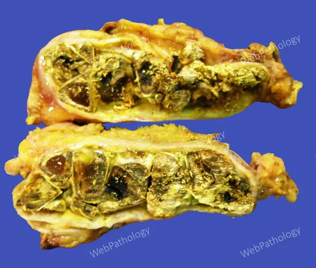 Brown Pigment Gallstones : Composition