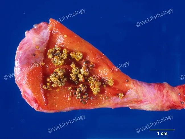 Brown Pigment Gallstones : Pathophysiology