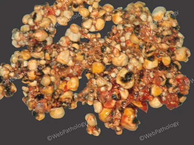 Brown Pigment Gallstones : Pathophysiology