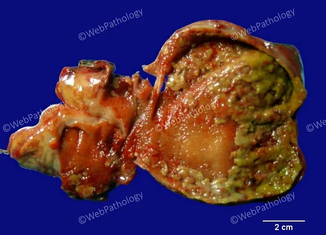 Acute Calculous Cholecystitis
