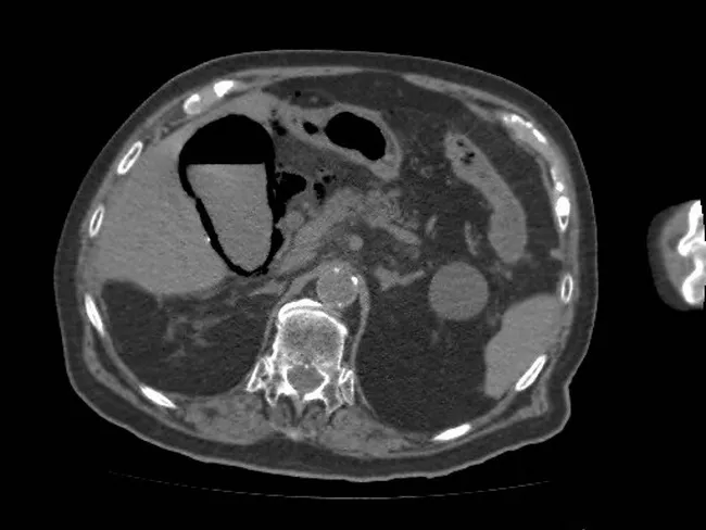 Acute Emphysematous Cholecystitis