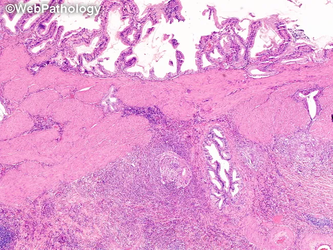 Chronic Calculous Cholecystitis