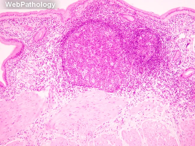 Chronic Calculous Cholecystitis