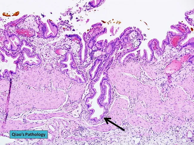 Chronic Calculous Cholecystitis
