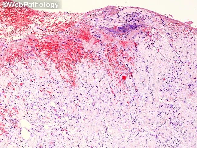 Chronic Calculous Cholecystitis