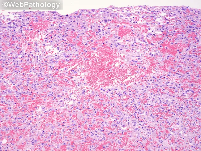 Chronic Calculous Cholecystitis