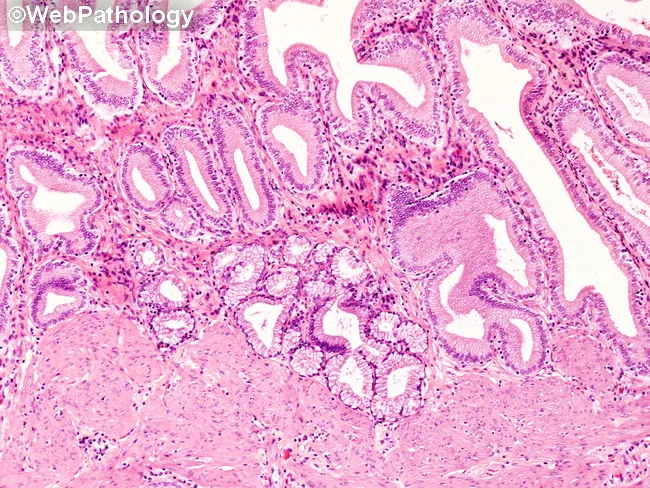 Chronic Cholecystitis : Metaplastic Changes