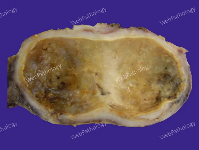 Porcelain Gallbladder