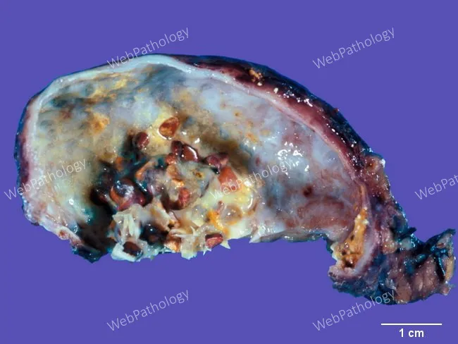 Porcelain Gallbladder