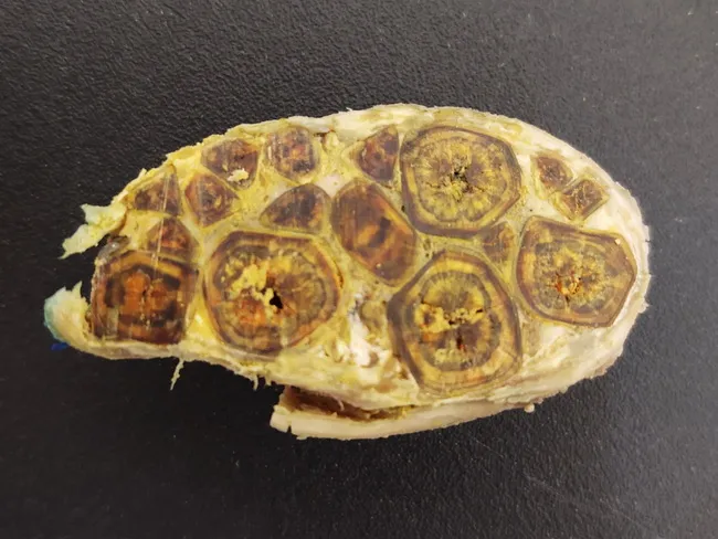 Porcelain Gallbladder