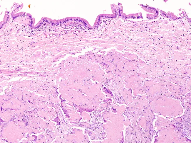 Gallbladder Amyloidosis