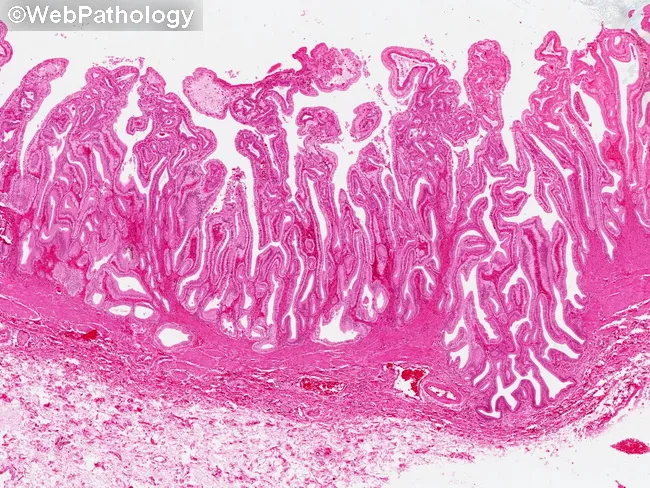 Gallbladder : Papillary Hyperplasia