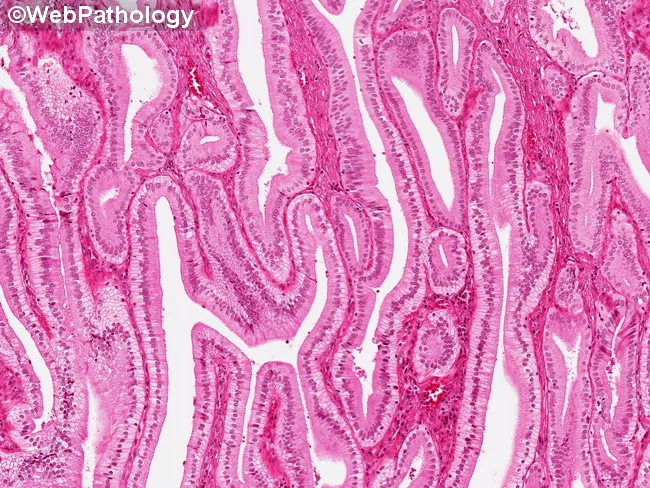 Gallbladder : Papillary Hyperplasia